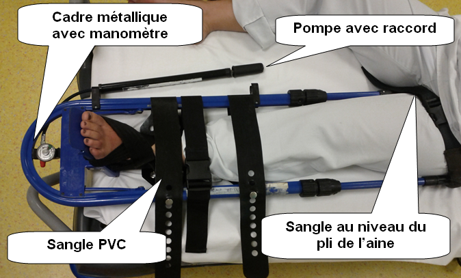 Attelle DONWAY - Médecine d'urgence - Urgences médicales